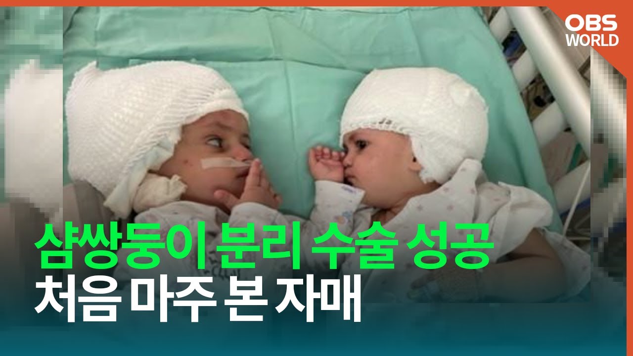 뒤통수 붙은 샴쌍둥이 자매 분리 수술 성공 Youtube