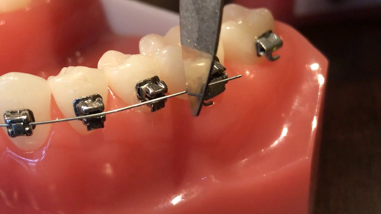 Fixing Braces at Home - YouTube