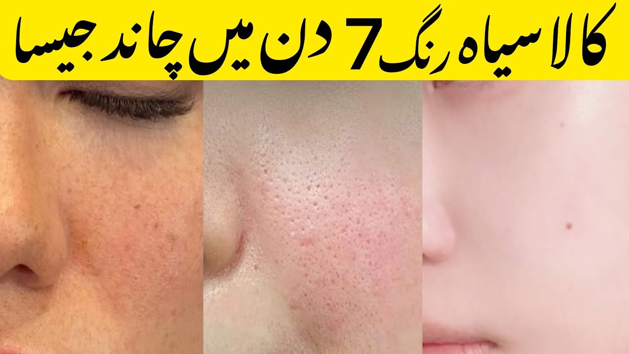 blackheads removal | Acne treatment | Acne & blackheads treatment ...