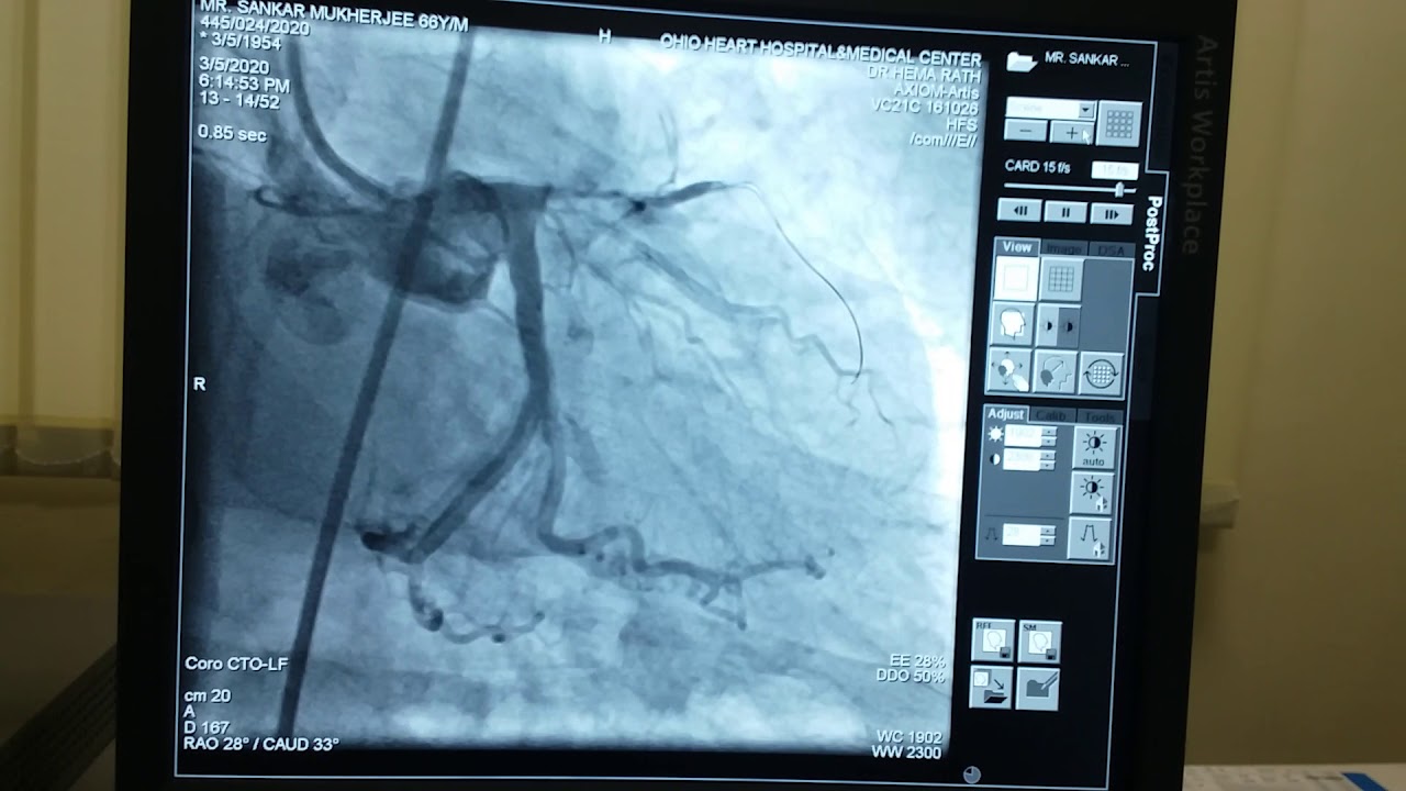 CAG + PTCA on 05/03/2020 - YouTube