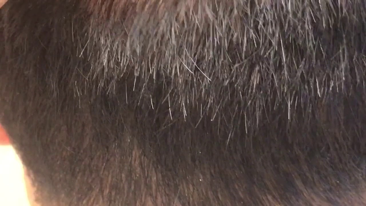 Closeup with Photos of FUT Donor Scar Correction with FUE - YouTube