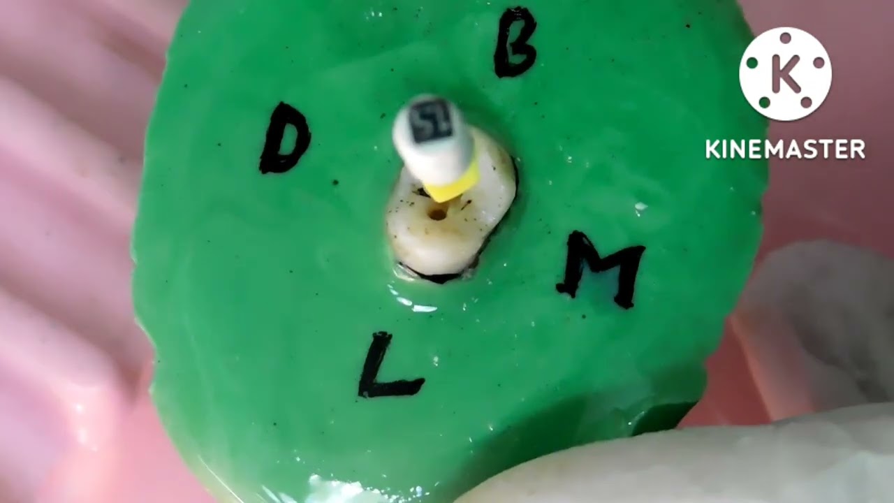 access opening of maxillary premolar. - YouTube