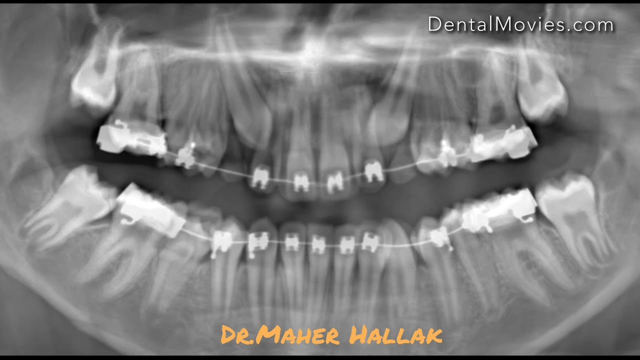 Canines Eruption - YouTube