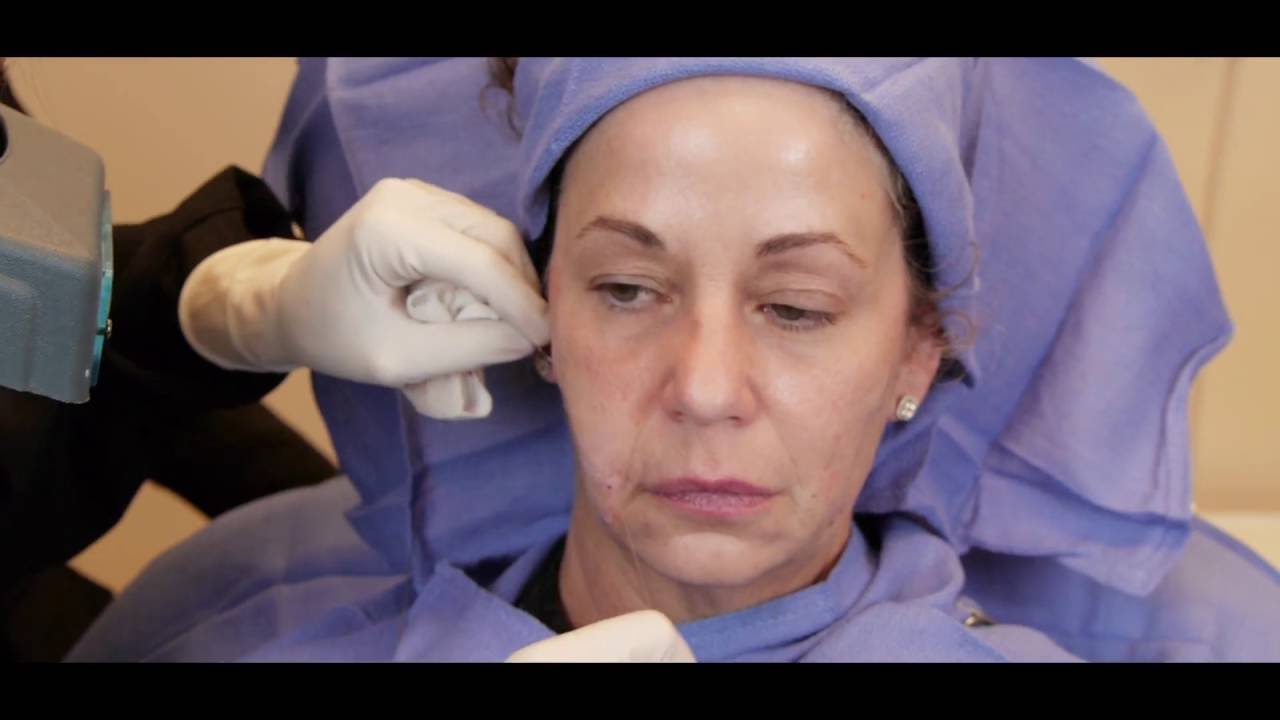 Watch Dr. Sally Booth perform a Silhouette Instalift procedure. - YouTube