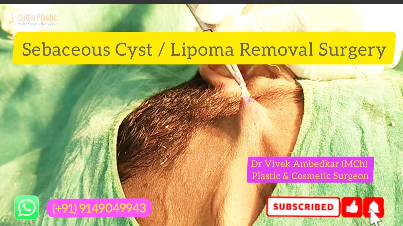 Sebaceous Cyst Removal Surgery | Lipoma Removal Surgery | Face Scar ...