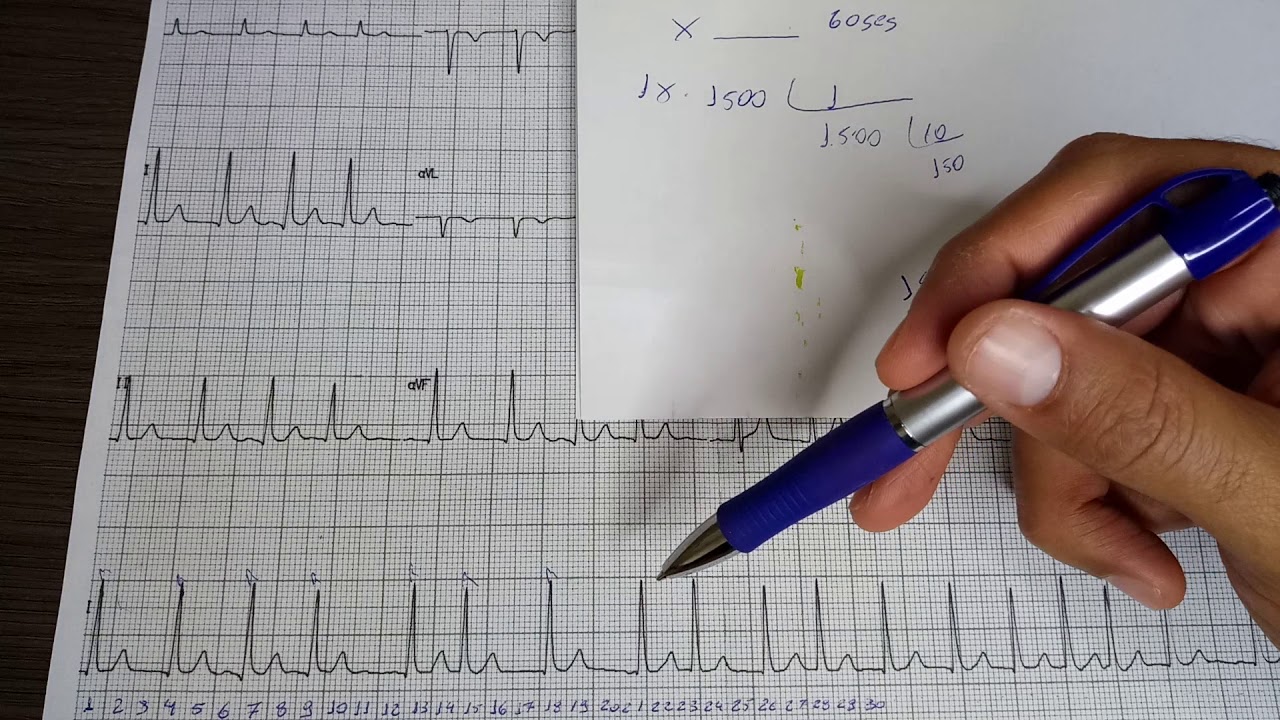 O Que é Ritmo Alfa Irregular - RETOEDU