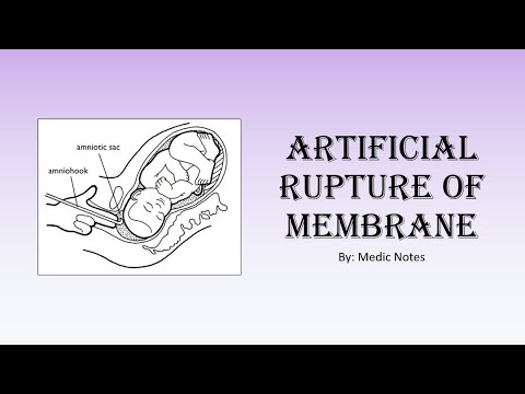 [Houseman preparation procedures] Artificial rupture of membrane ...
