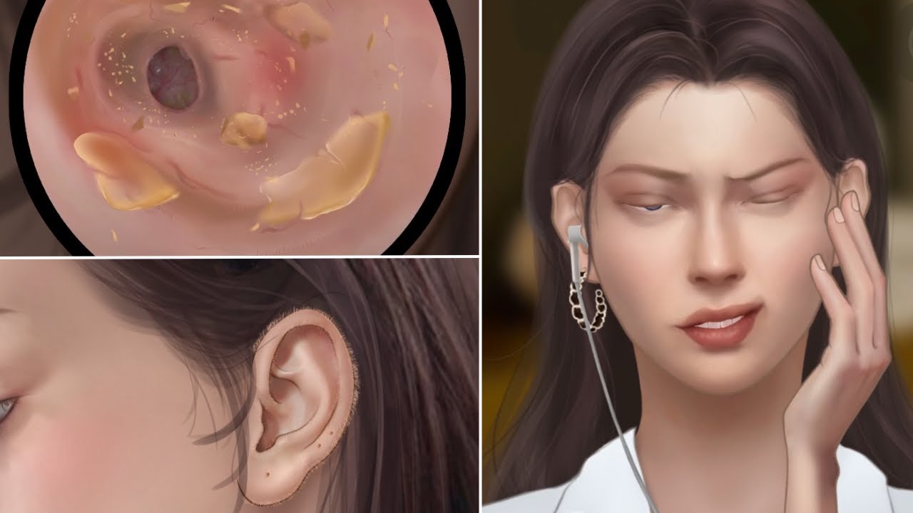 Satisfying Ear Cleaning Therapy | ASMR pimple, blackhead removal ...