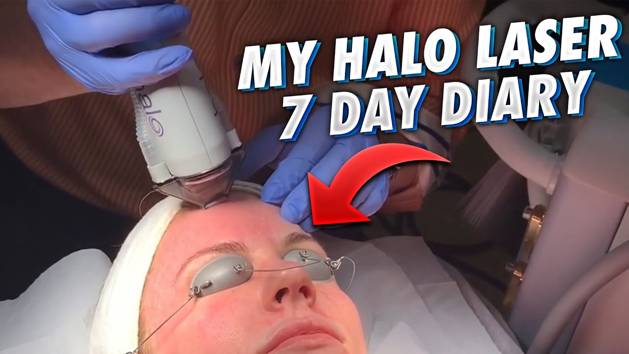 My Halo Procedure - Day by Day Recovery Diary \ Honest Review - YouTube