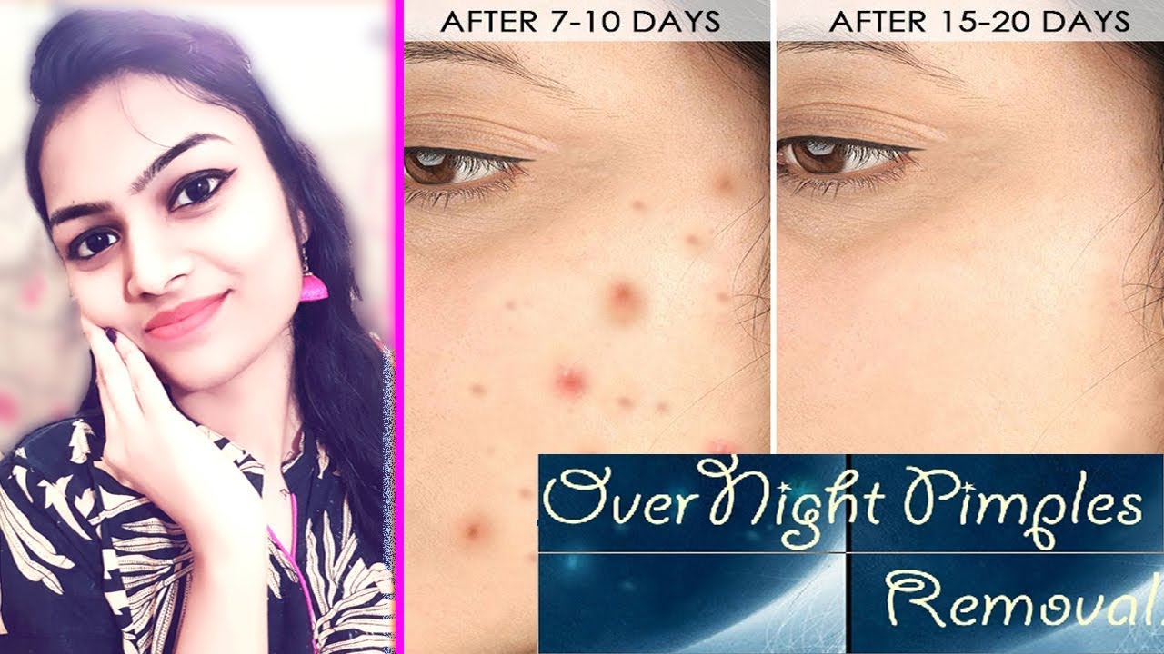 Remove Pimples & Acne Overnight – Acne Treatment | Natural Home Remedy ...