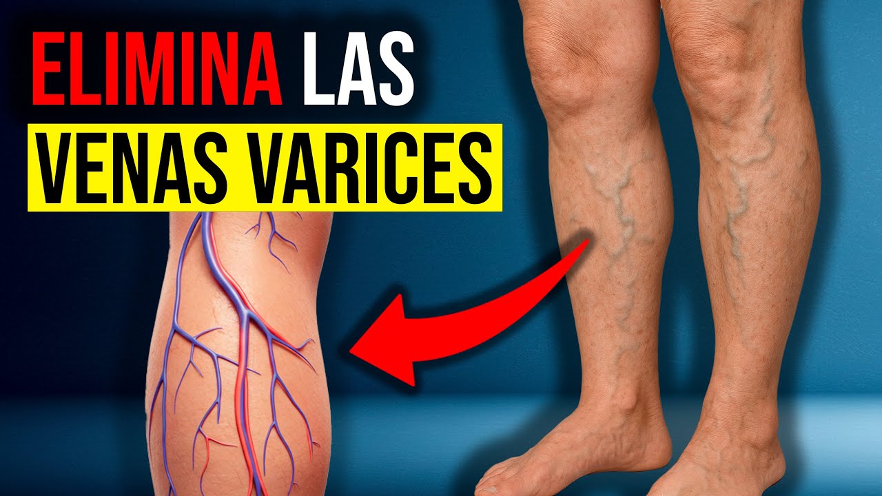 5 CLAVES INFALIBLES para PREVENIR VARICES desde HOY 💥 - YouTube