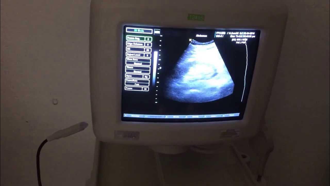 Medison Sonoace 8000 Live Youtube