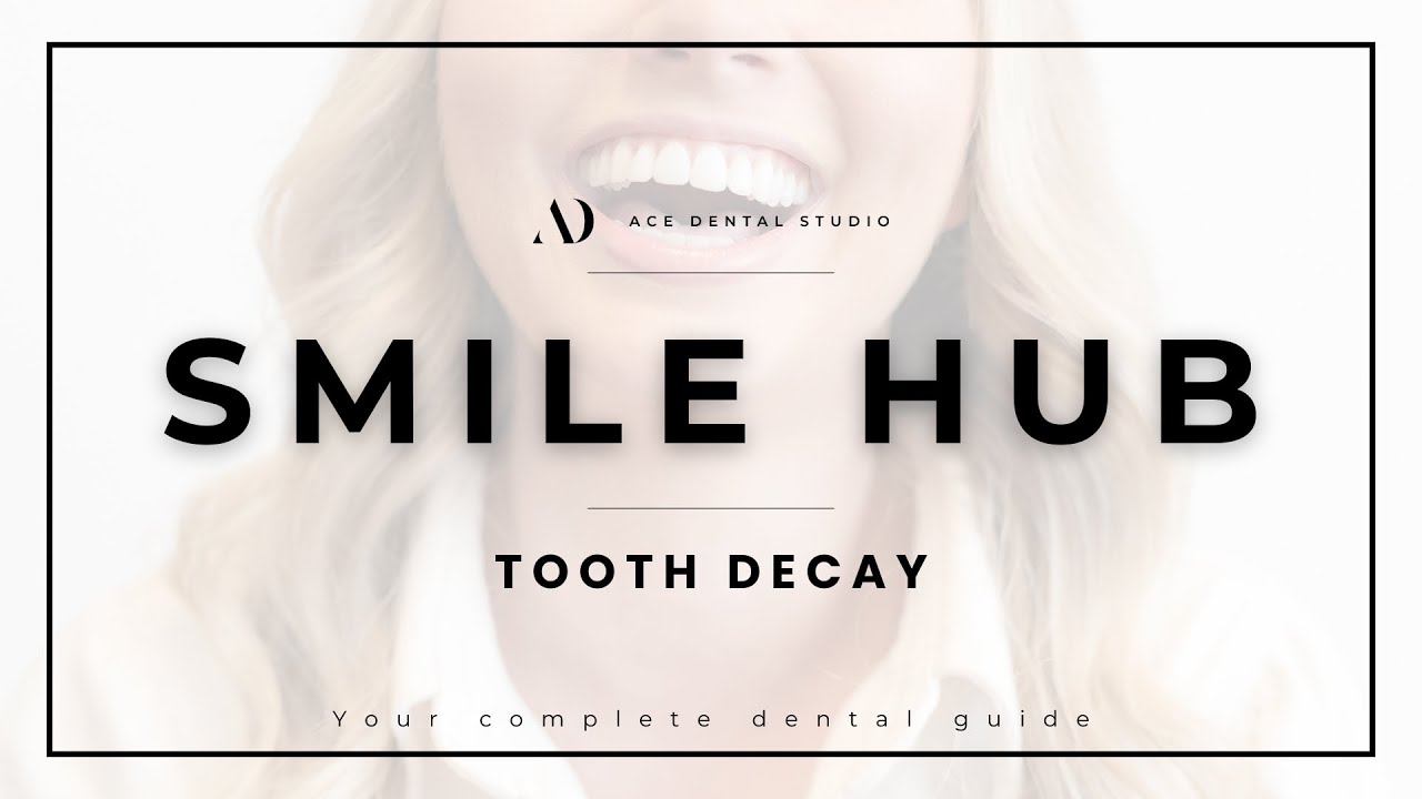 Understanding Tooth Decay: Your Comprehensive Guide | Ace Dental Studio ...