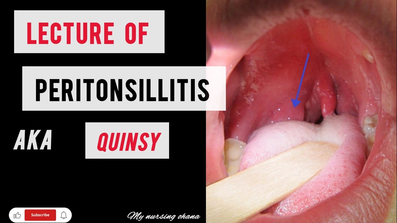 Lecture of Peritonsillitis in medical surgical nursing-2,# ...