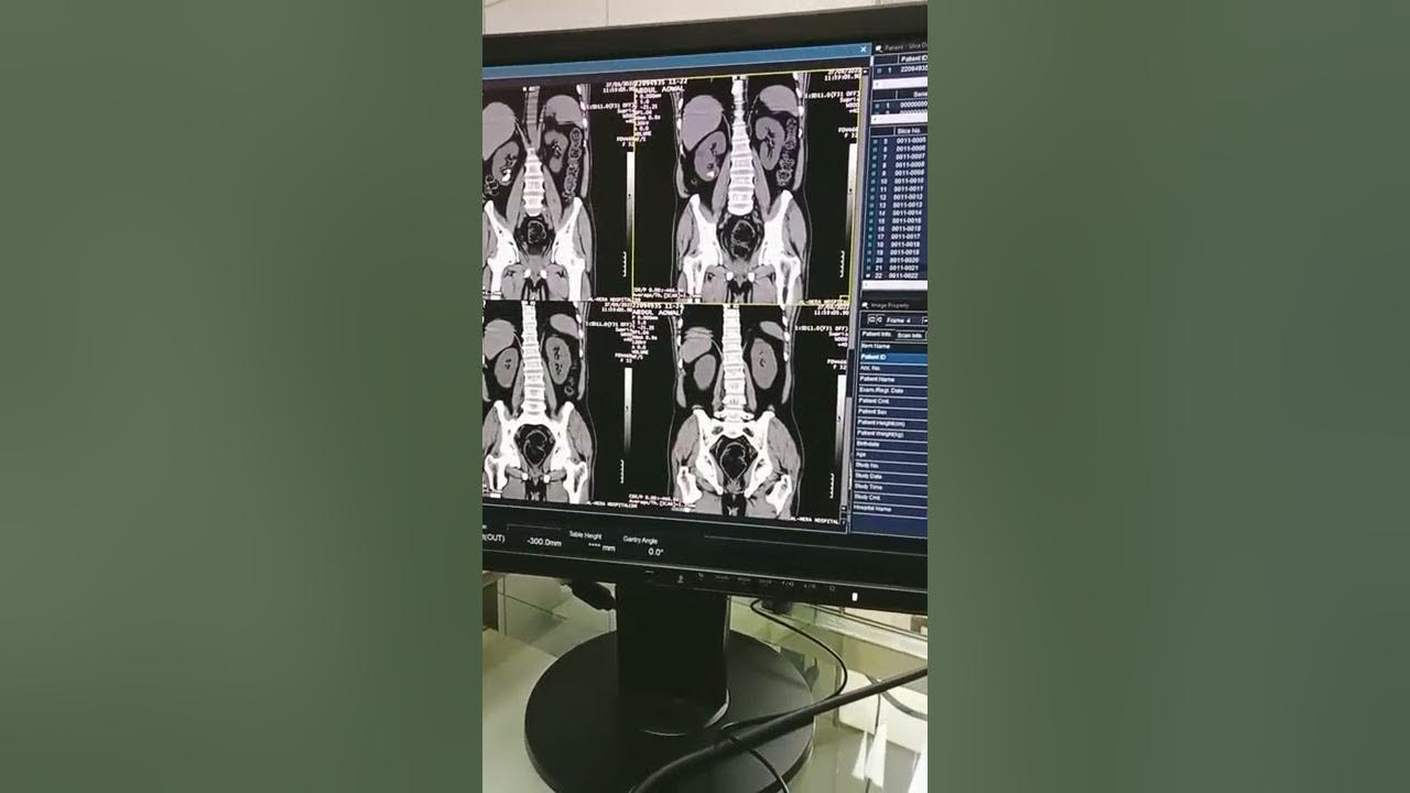 Non Contrast CT. Scan of KUB Filming - YouTube