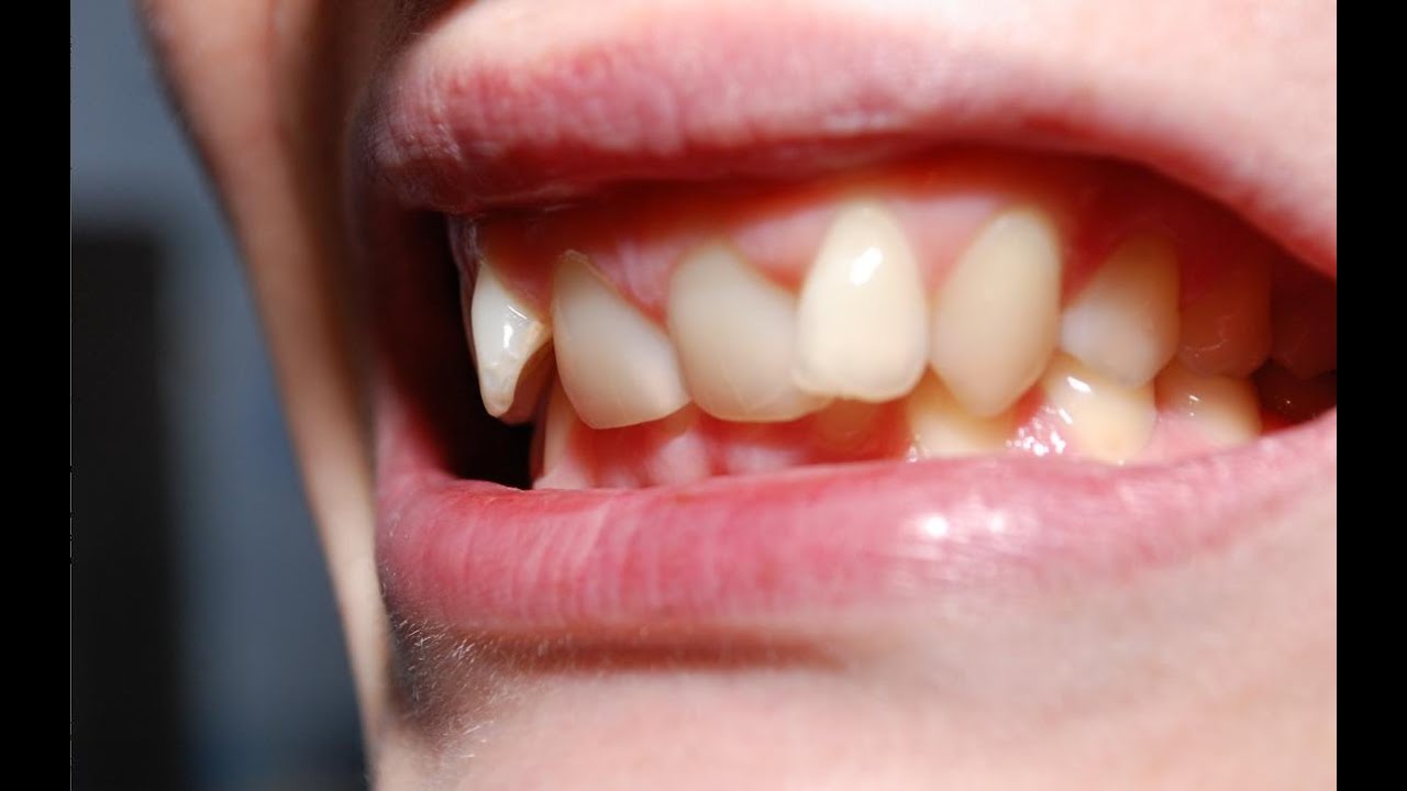 How to straighten uneven teeth without braces, using a mouth guard? Can ...