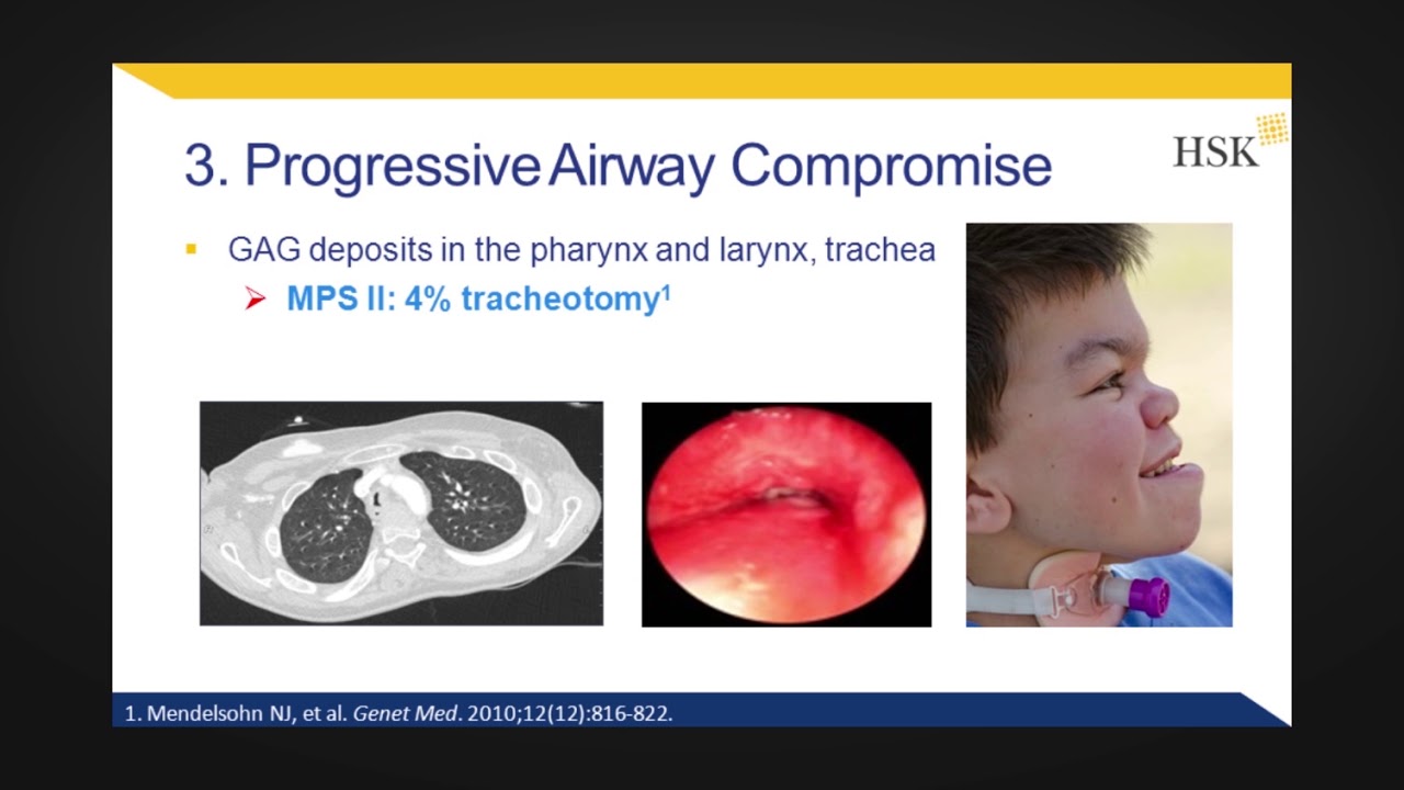Surgery and otorhinolaryngology: MDT management of Hunter syndrome (MPS ...