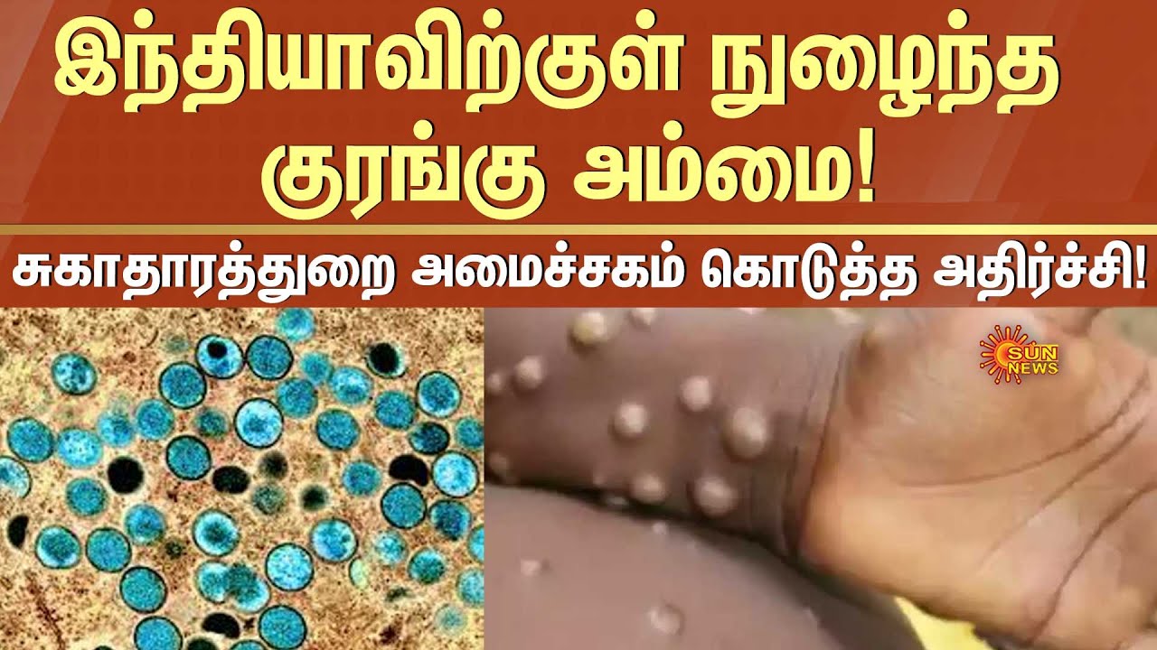 Monkey Pox In India | Monkey Pox | Virus | India | Quarantine ...