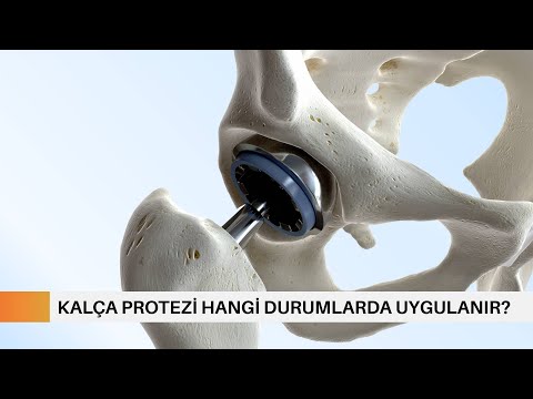 Kalça protezi hangi durumlarda uygulanır? | Prof. Dr. Yakup YILDIRIM