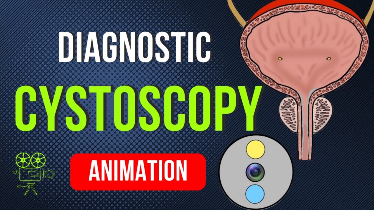 DIAGNOSTIC CYSTOSCOPY ANIMATION - YouTube