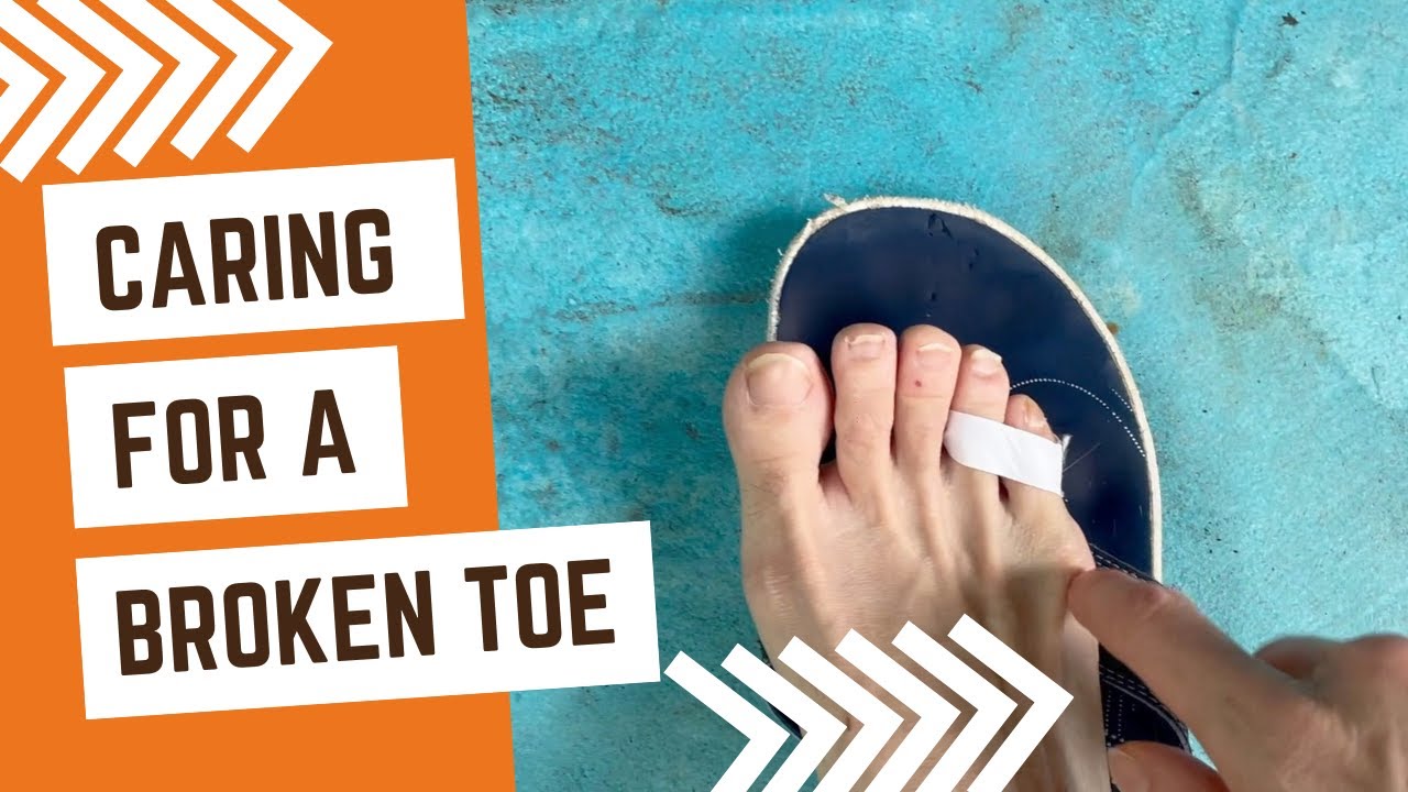 How To Treat a Broken Toe? - YouTube
