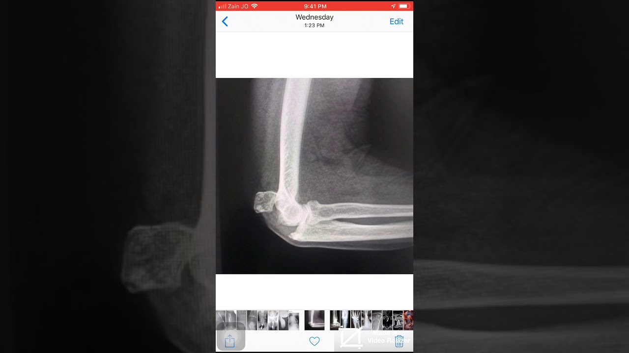 Case 064 displaced or avulsed olecranon process fracture - YouTube