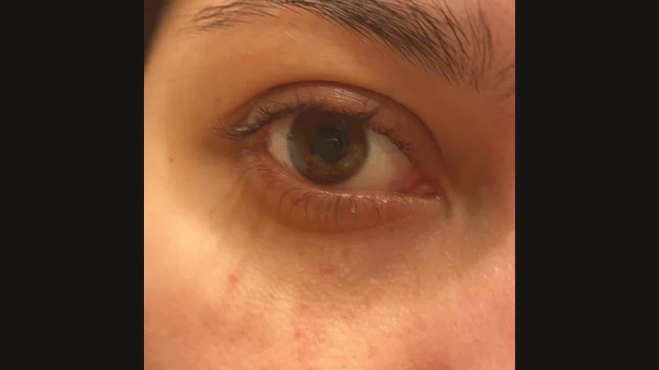 Pulling Out Eye Mucus Discharge From Having Eye Allergies YouTube
