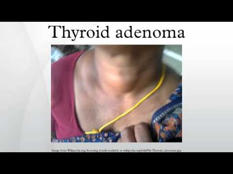 Thyroid Adenoma