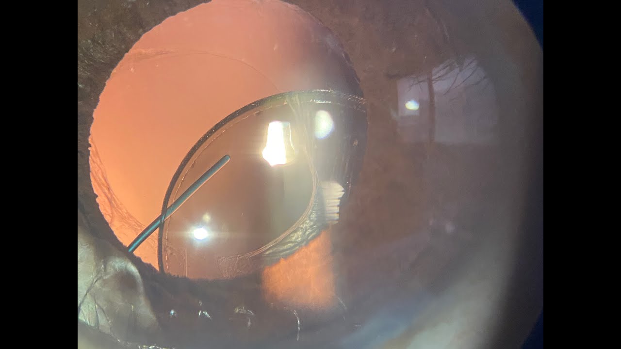 Haptic Iris Fixation for IOL Stability - YouTube