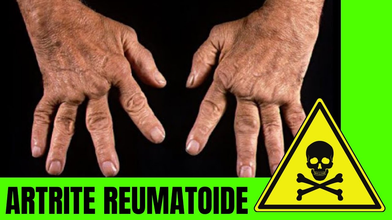 Artrite Reumatoide: O que é? Como é o Diagnostico? Como é feito o ...