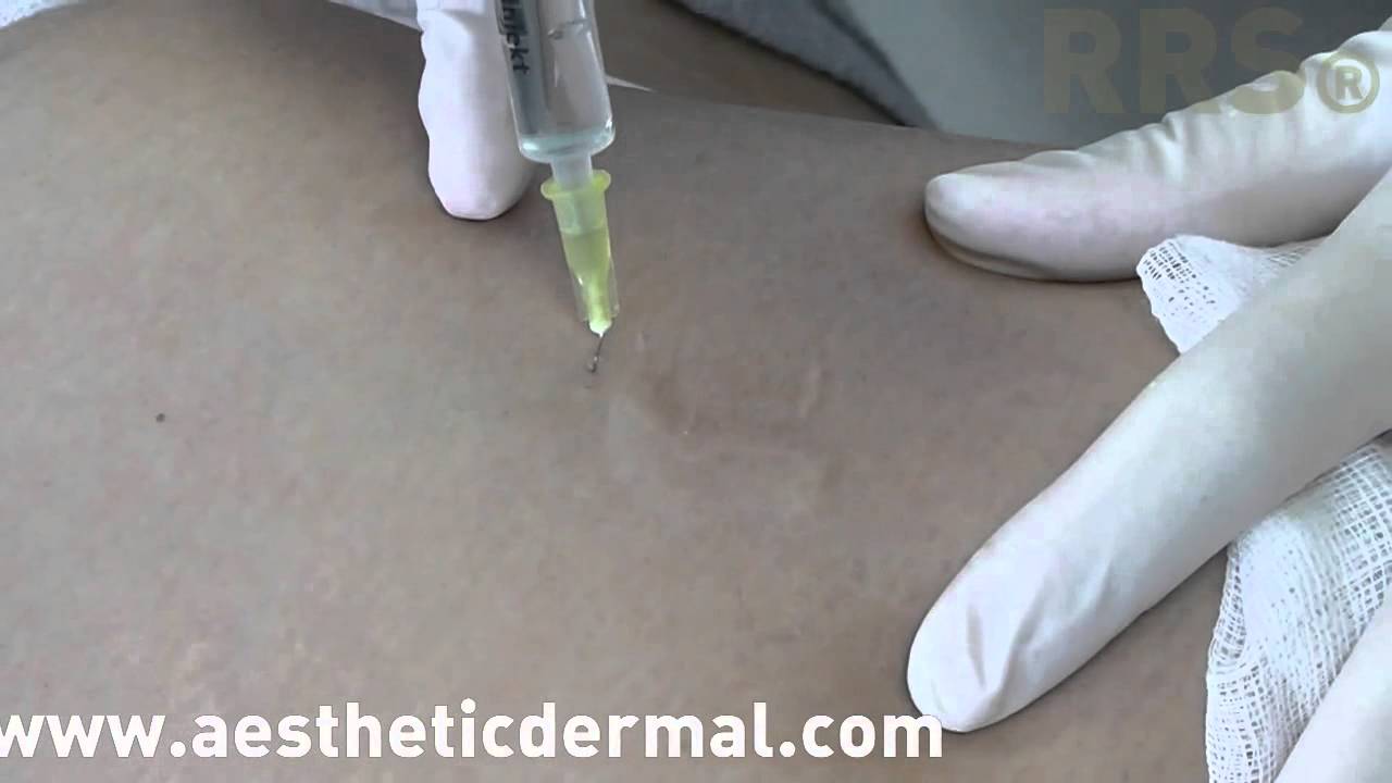 RRS Strimatrix tratamente vergeturi thinghs Cross tehnica - YouTube