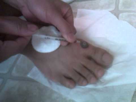 Draining a blood blister - YouTube