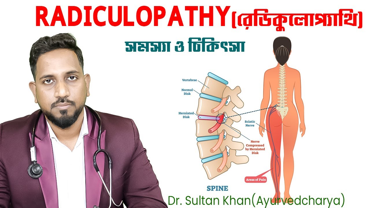 Radiculopathy: Type, Symptoms, Causes & Treatment - What is the best ...
