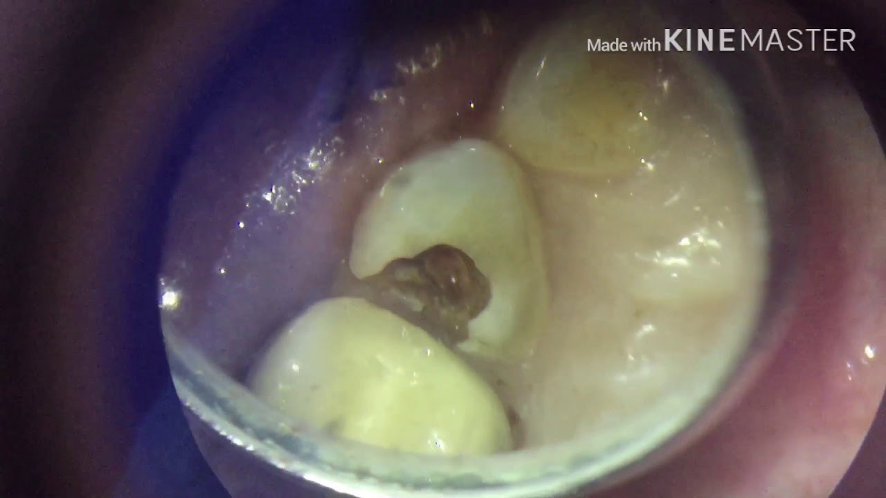 Acess opening of upper canine and canal preparation with rotary ...