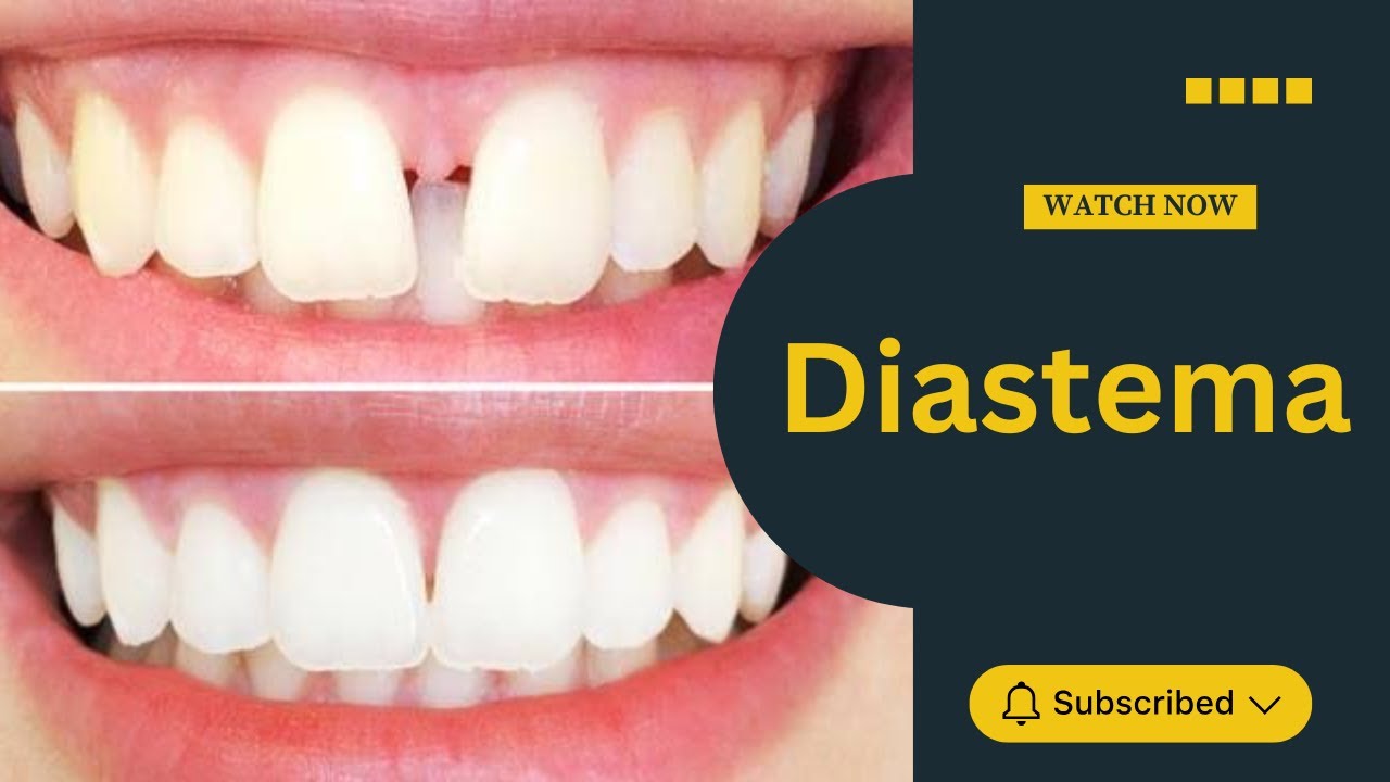 What is a diastema in dentistry ? / Diastema / Dental Diastema # ...
