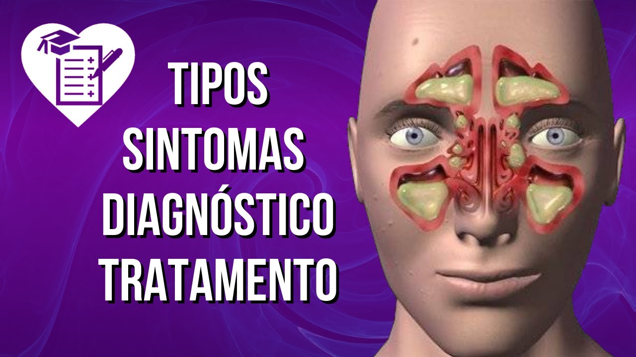 SINUSITE - Causas, Sintomas e Tratamento - YouTube