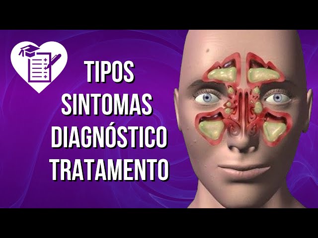 Sinusite Alérgica: O Que É, Sintomas, Causas E Tratamento – SIVZJI
