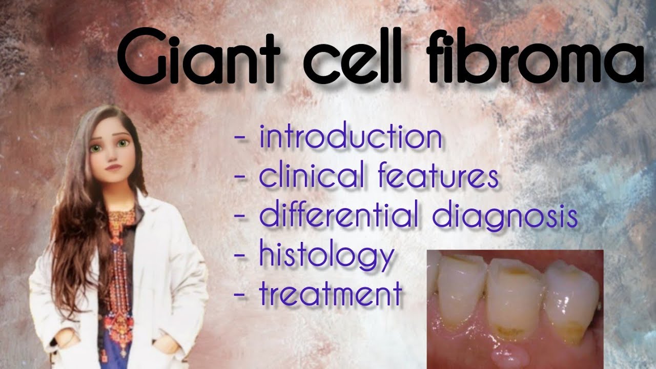 Giant cell fibroma | Benign non epithelial tumors of oral cavity - YouTube