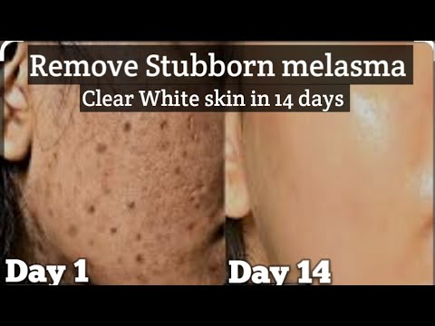 Get White Skin In 14 Days || Stubborn Melasma || Chaion Se Preshan ...