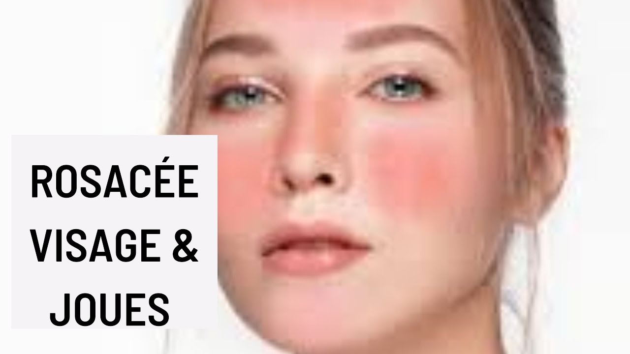 Rosacée visage & joues : Traitements, crèmes & soins - YouTube
