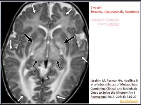 52. Canavan disease; leukodystrophy, Ashkenazi Jewish carrier, NAA ...