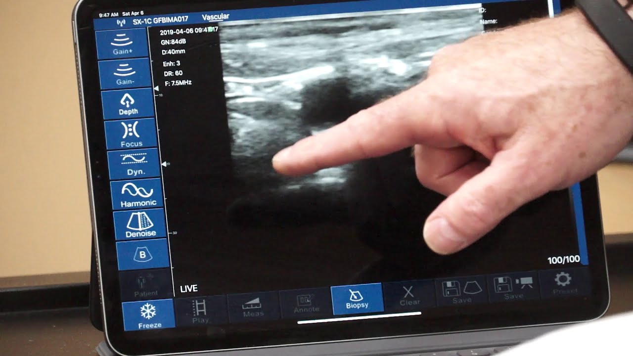 How To Use Your SonoStar Wireless Ultrasound Probe - YouTube