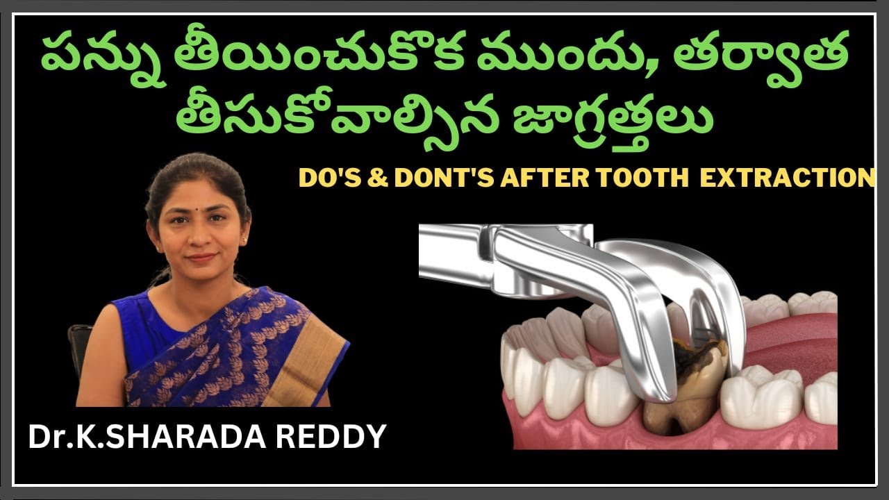 పన్ను తీయించుకొక ముందు, తర్వాత తీసుకోవాల్సిన జాగ్రత్తలు | TOOTH ...