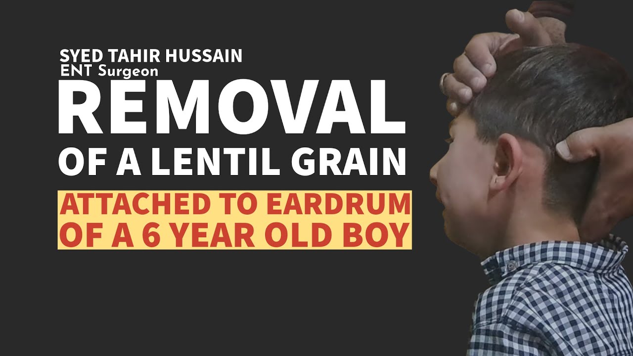 Removal of an Old Lentil Grain Stuck to the Eardrum in a 6-Year-Old ...