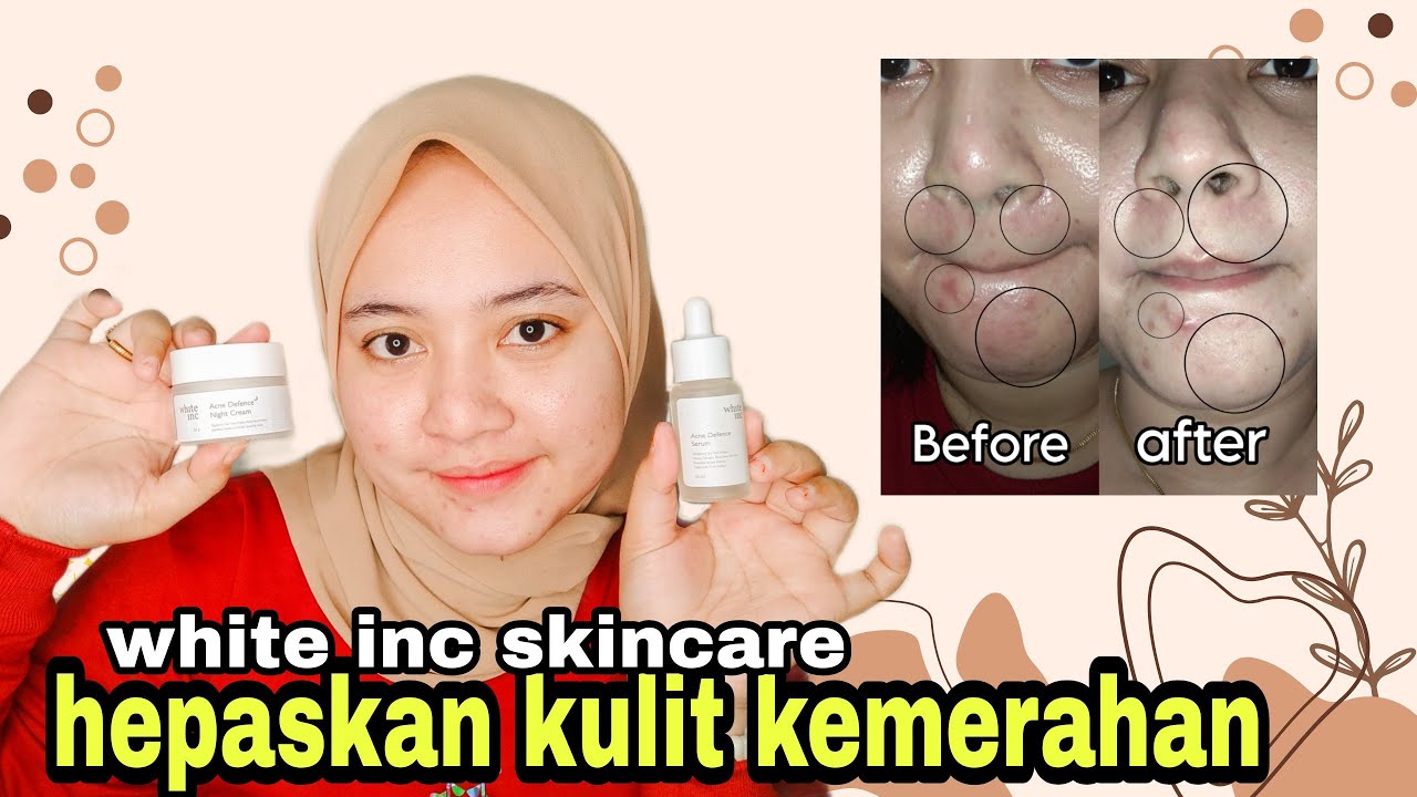 REVIEW WHITE INC SKINCARE ACNE - YouTube