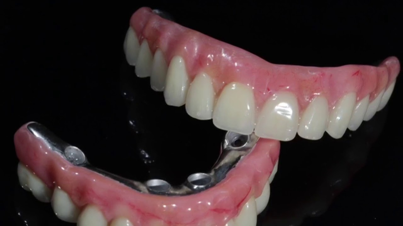 Curso de Protocolo de Branemark Frezato - YouTube