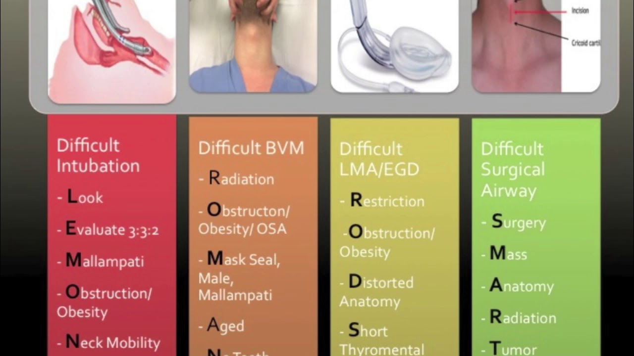 Pre Intubation Airway Assessment YouTube