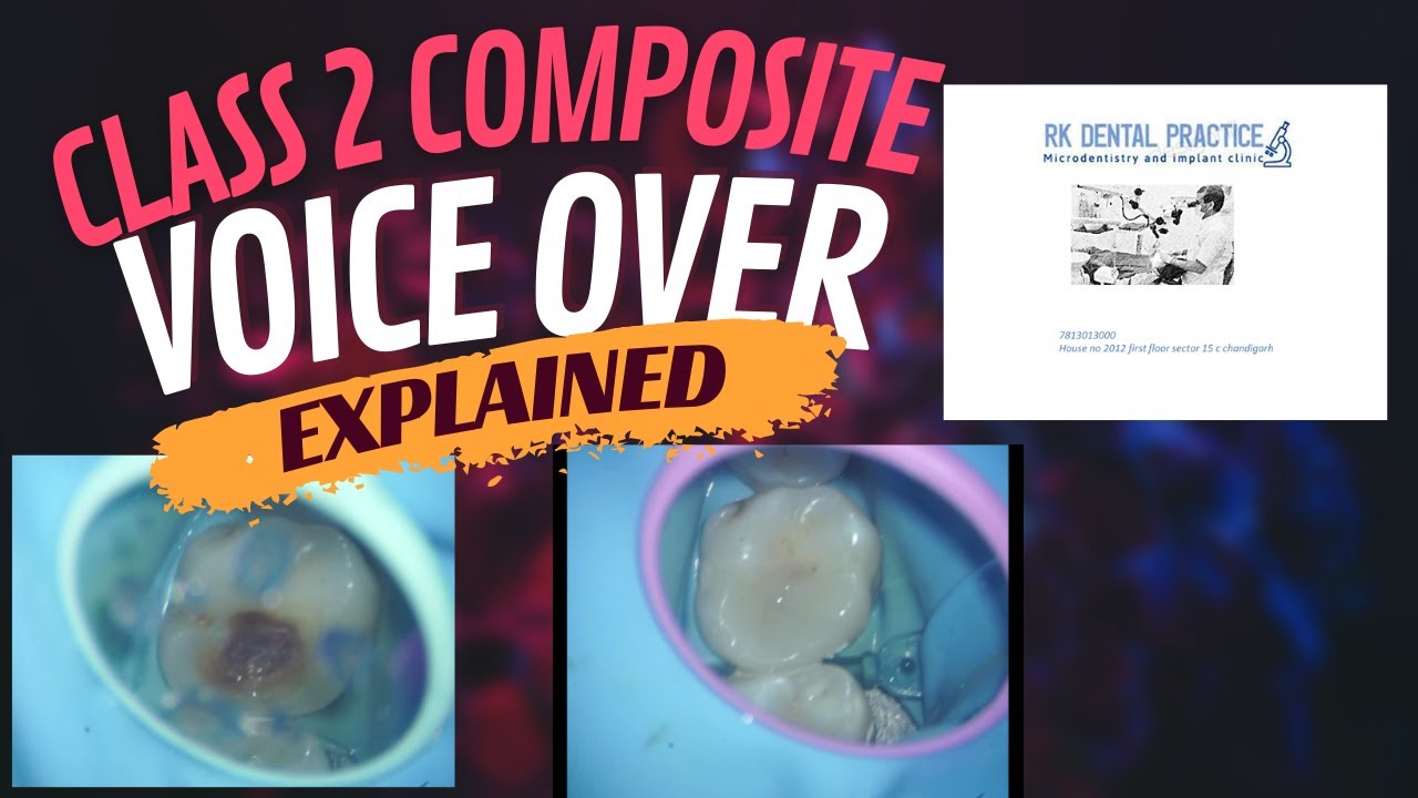 class 2 composite restoration step by step| composite restoration with ...