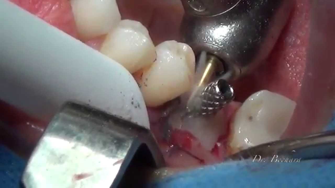 Immediate Implant placement in Lower molar area. By. Dr. Bechara - YouTube