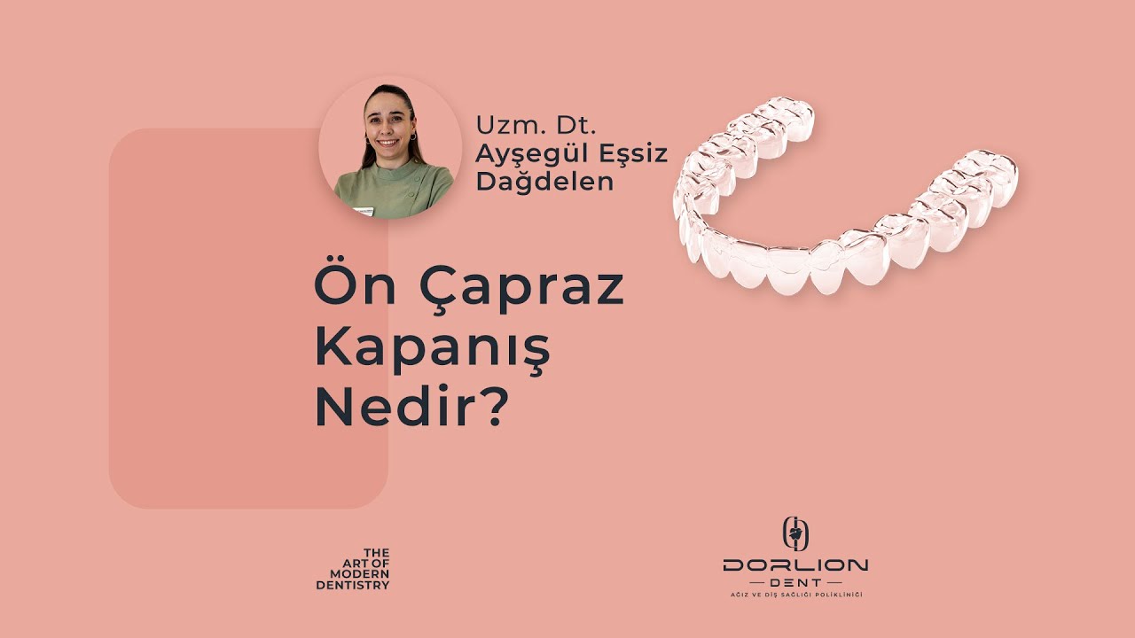 Ön Çapraz Kapanış Nedir? | Dorlion Dent - YouTube